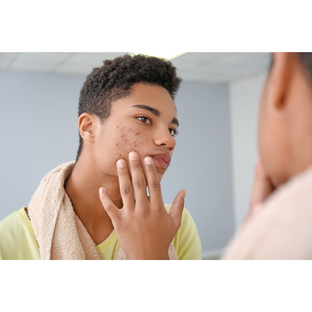 Acne – H&H Aesthetic Medicine Skin Care